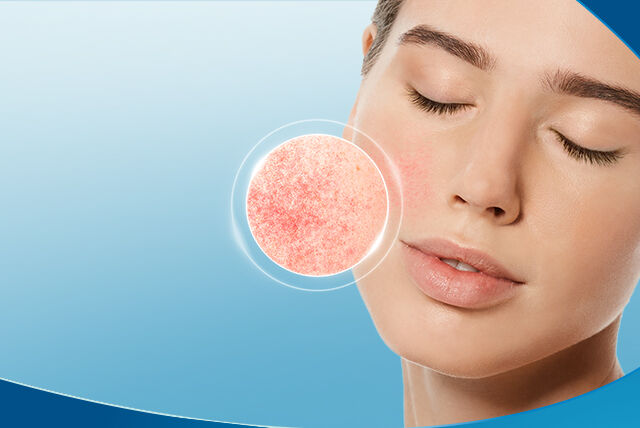 Reduce Skin Redness And Control Rosacea | Cetaphil UK